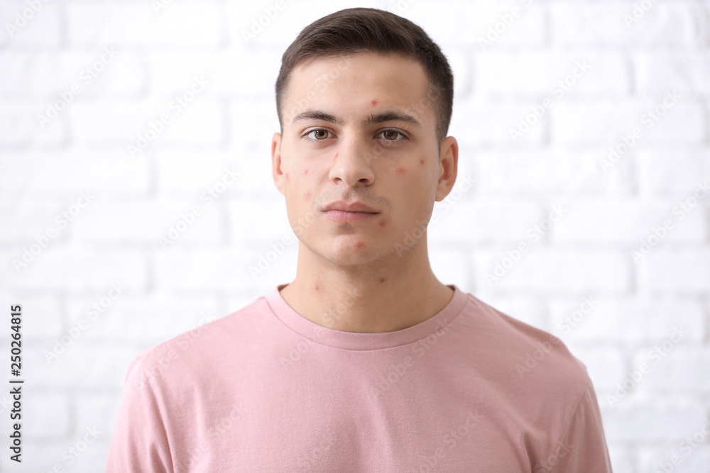 Portrait of young man with acne problem against white brick wall Stock ...