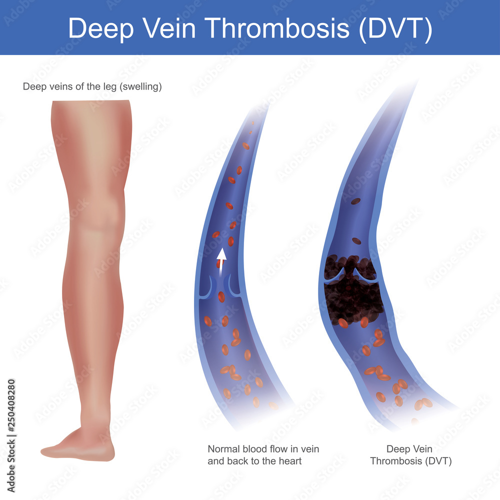 Deep vein thrombosis. Stock Vector | Adobe Stock