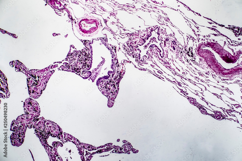 Histopathology of lung emphysema, light micrograph, photo under ...