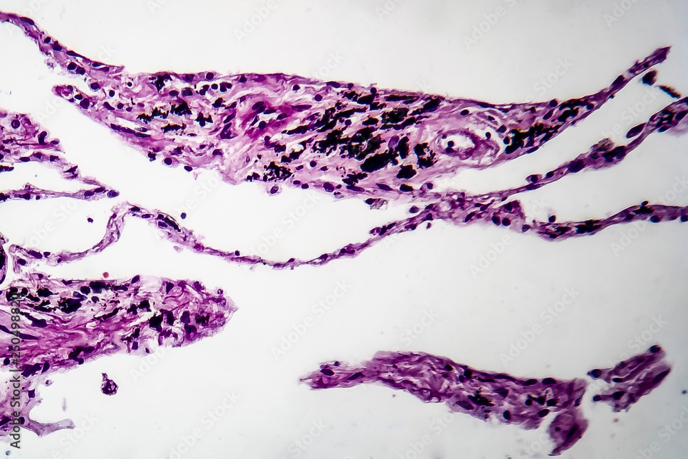Histopathology of lung emphysema, light micrograph, photo under ...