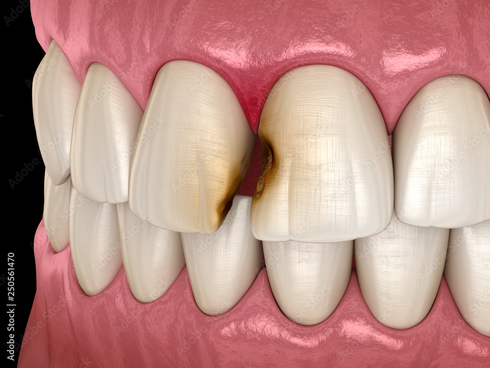 Central incisor teeth damaged by caries. Medically accurate tooth 3D ...