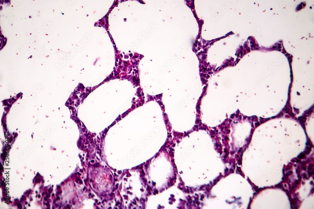 Histopathology of pneumonia, light micrograph, photo under microscope ...