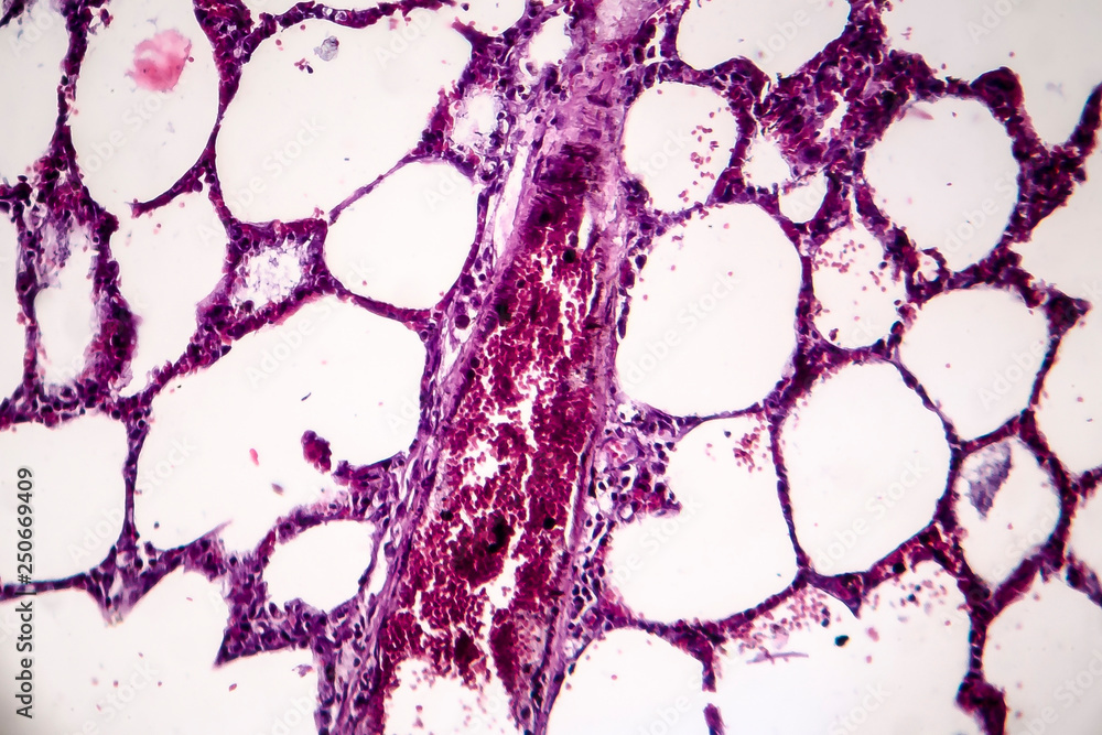 Histopathology of pneumonia, light micrograph, photo under microscope ...