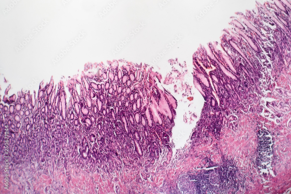 Histopathology of chronic atrophic gastritis, light micrograph, photo ...