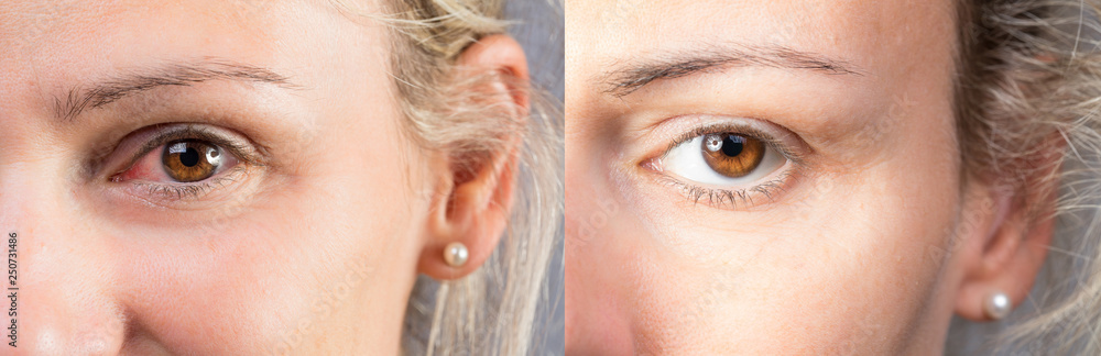 Comparison between before and after treatment with eye drops for red ...