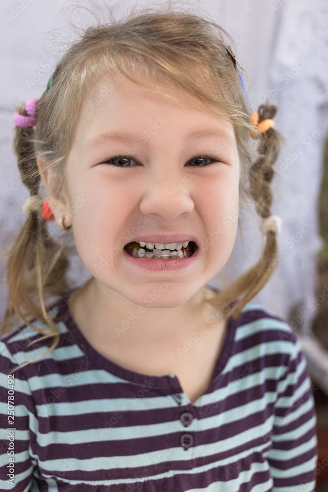 Adult permanent teeth coming in front of the child's baby teeth: shark ...