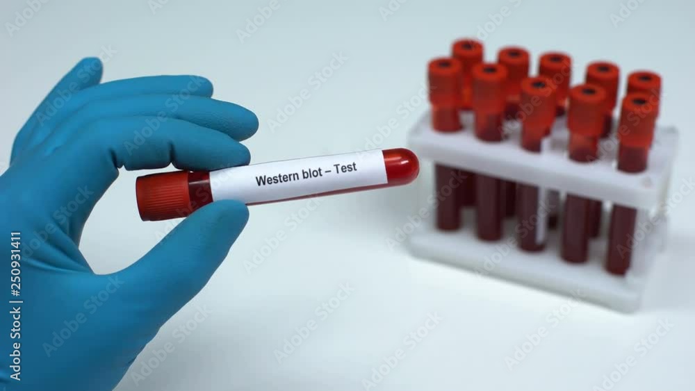 Western blot, doctor showing blood sample in tube, lab research, health ...