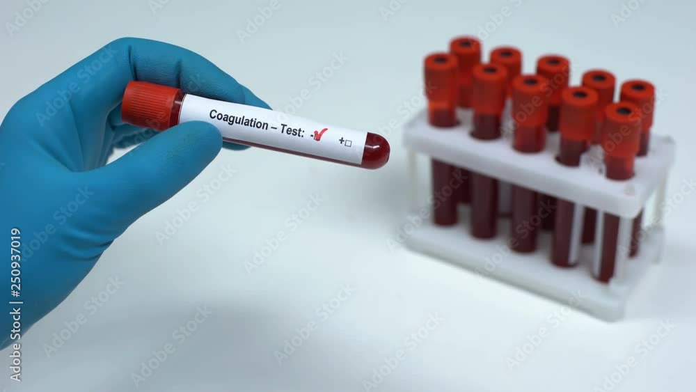 Negative coagulation test, doctor showing blood sample, lab research ...