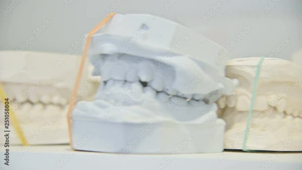 Dental gypsum model cast of human dental jaw. Laboratory prosthetics ...