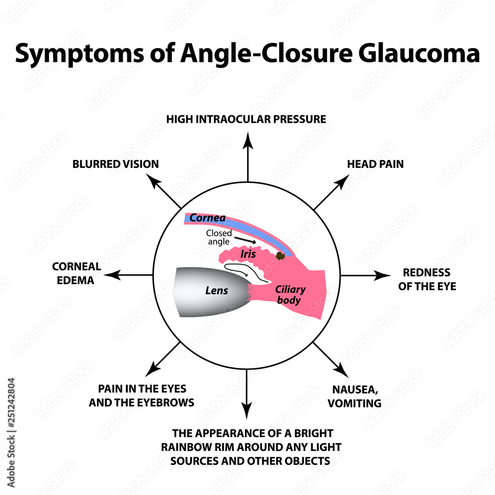 The symptoms of closed angle glaucoma. World glaucoma day. The ...