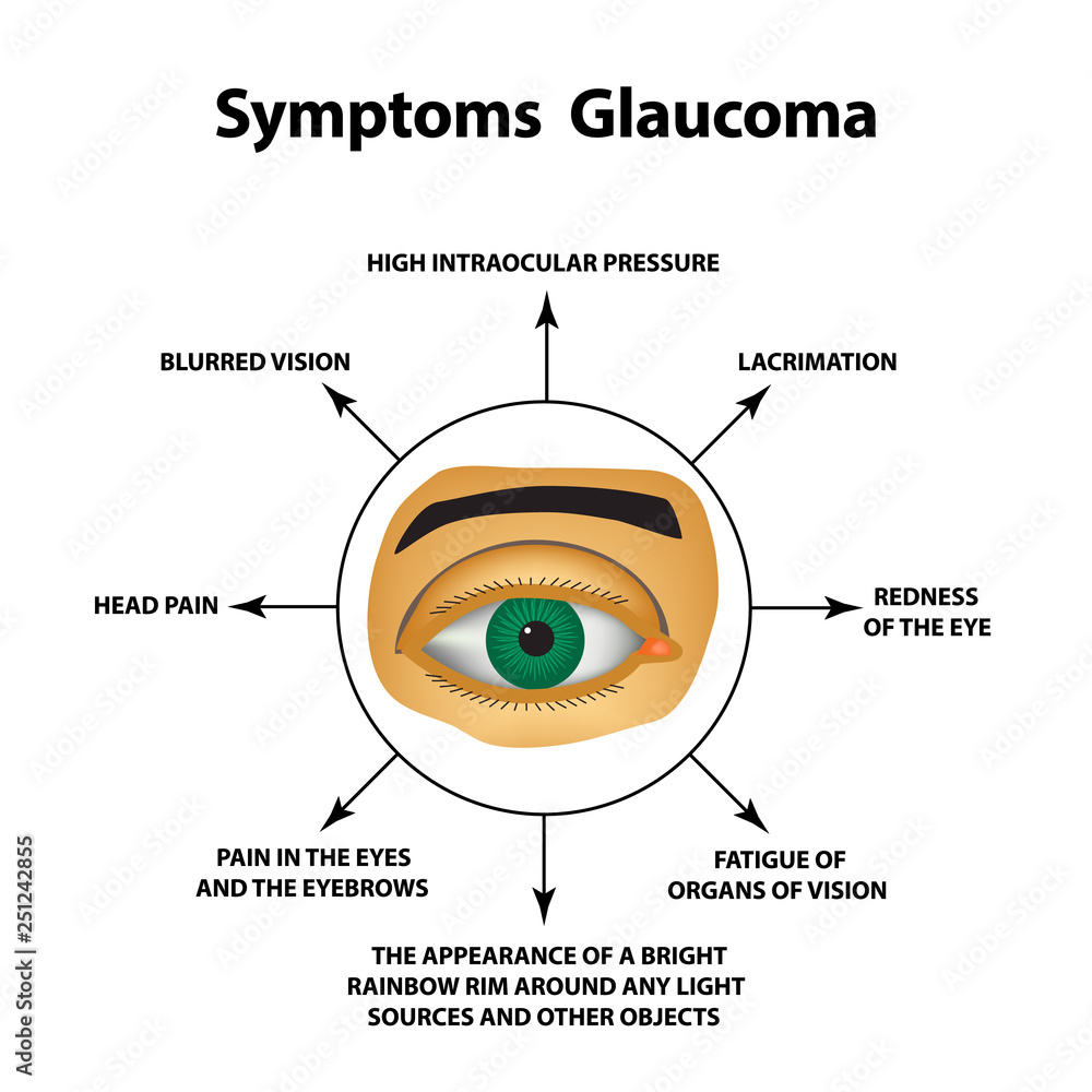 Vecteur Stock Symptoms of glaucoma. World glaucoma day. The anatomical ...