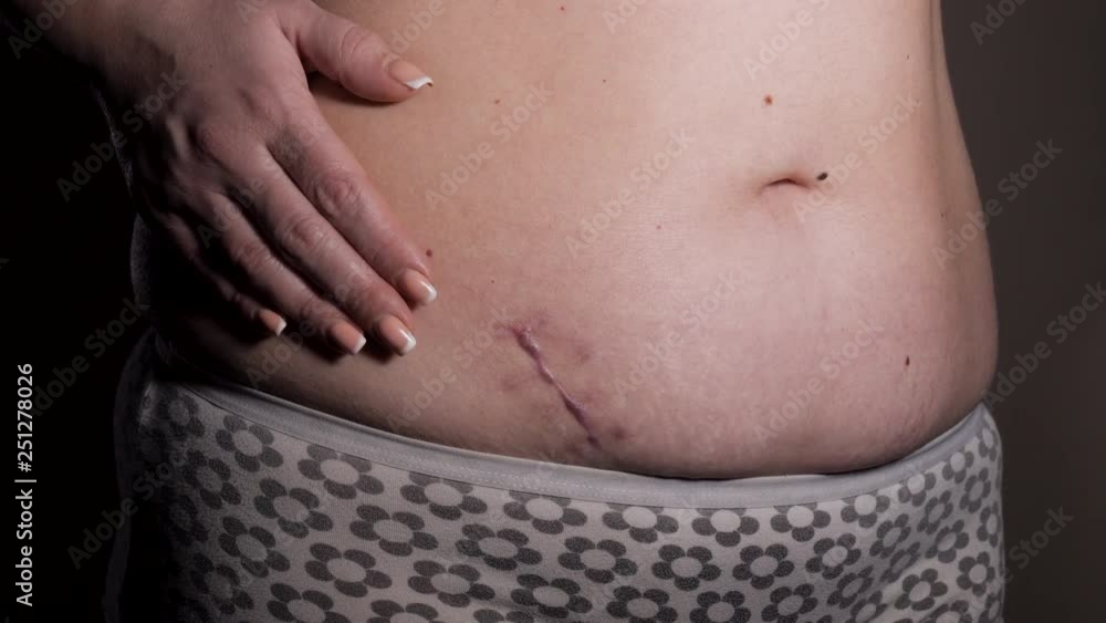 Woman showing the stomach with a appendicitis scar after surgery. Scar removal Stock Video ...