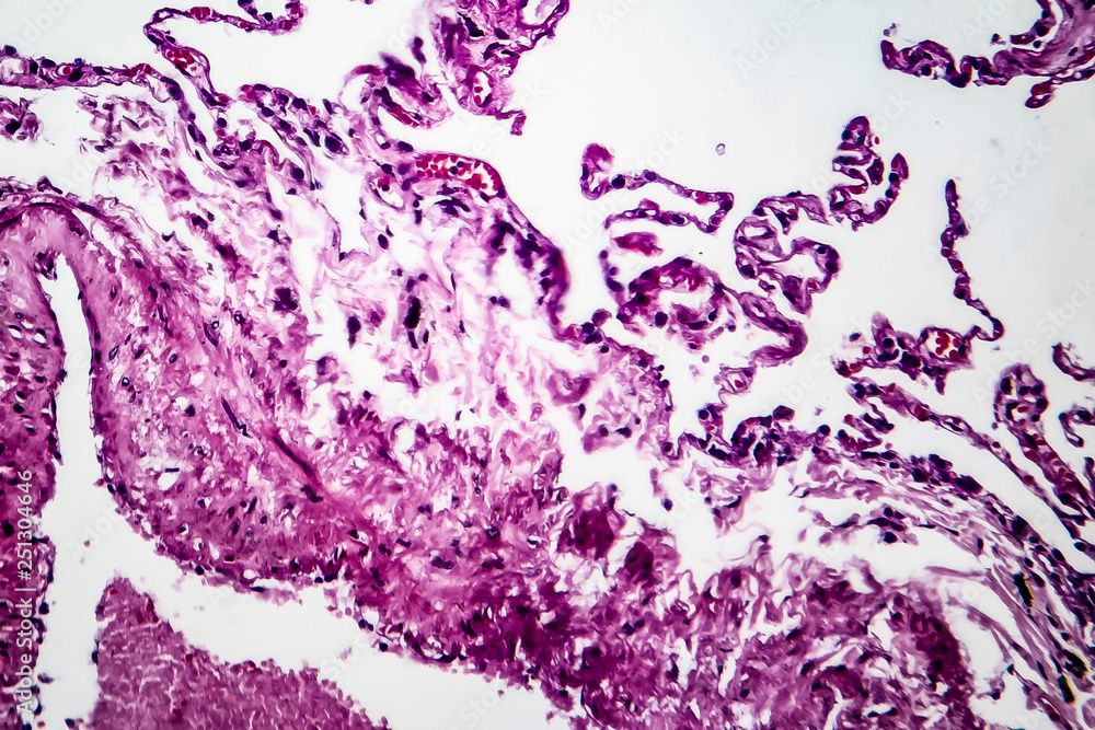 Histopathology of lung emphysema, light micrograph, photo under ...