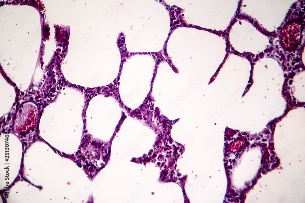 Histopathology of pneumonia, light micrograph, photo under microscope ...