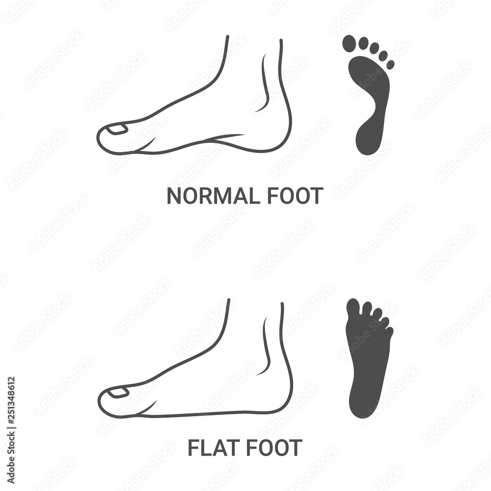 Foot Pathologies, Normal, Flat Foot Isolated On A White Background ...