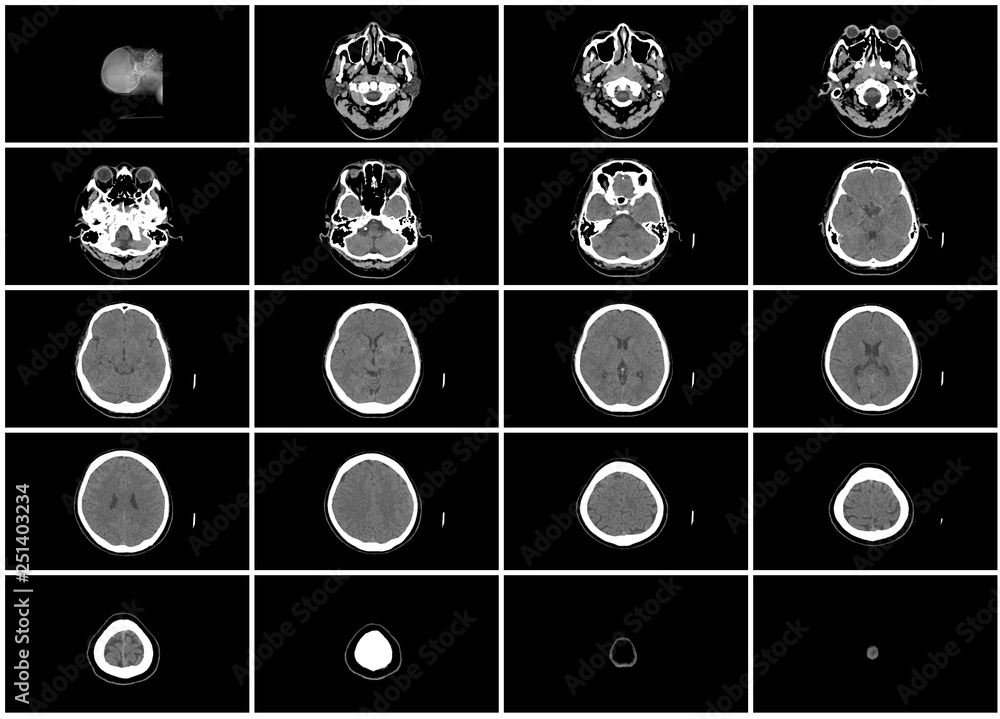 ct scan step set of upper brain head axial top view Stock Photo | Adobe ...