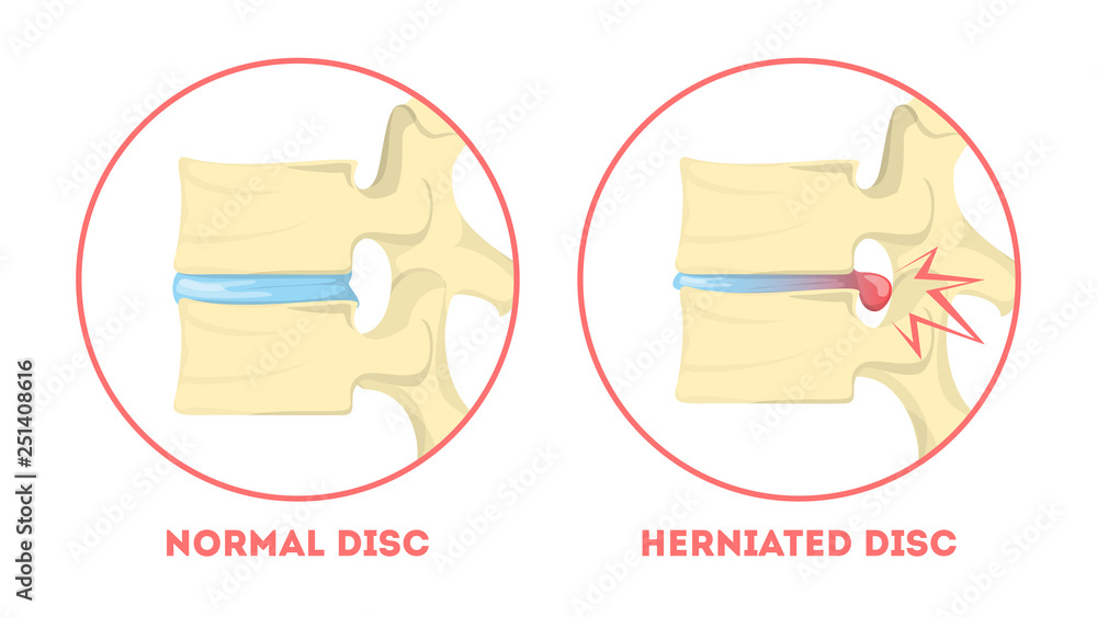 Disc degeneration. Human anatomy. Spine problem. Healthy Stock Vector ...