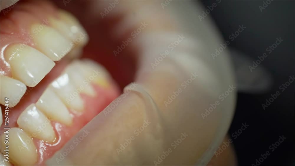 Dentist examining a patient's teeth in the dentist. Examination of the ...