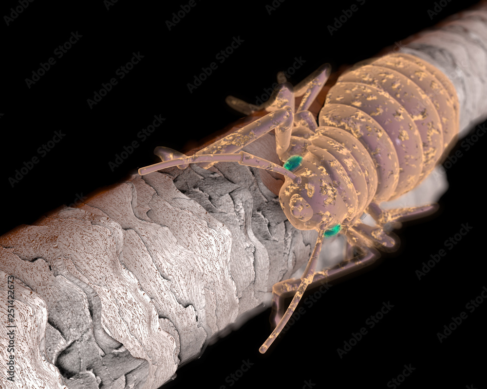 Louse on hair close up as a medical problem concept as follicles with ...