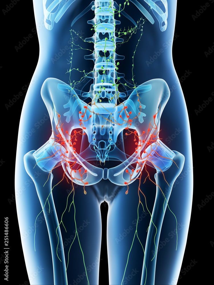 3d rendered illustration of a females inflamed abdominal lymph nodes ...