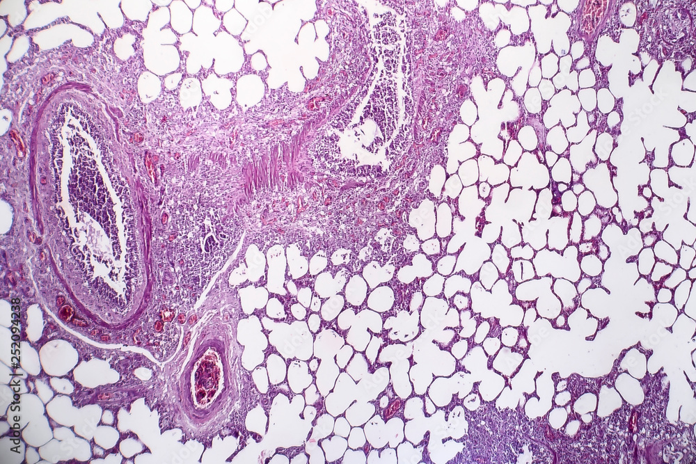 Histopathology of pneumonia, light micrograph, photo under microscope ...