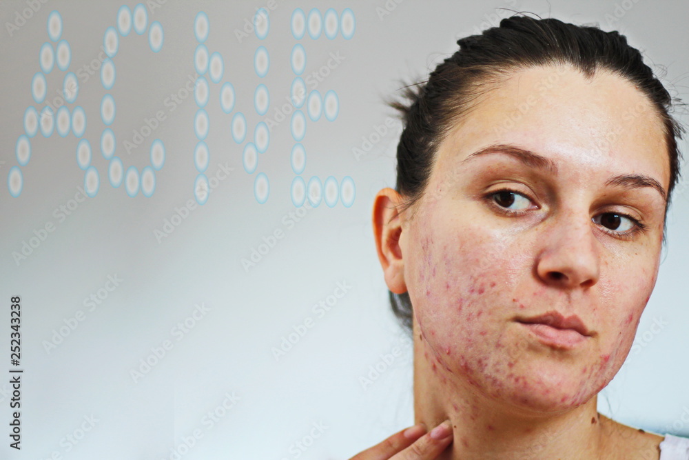 Acne on the face of young women. Improper therapy has led to a severe ...