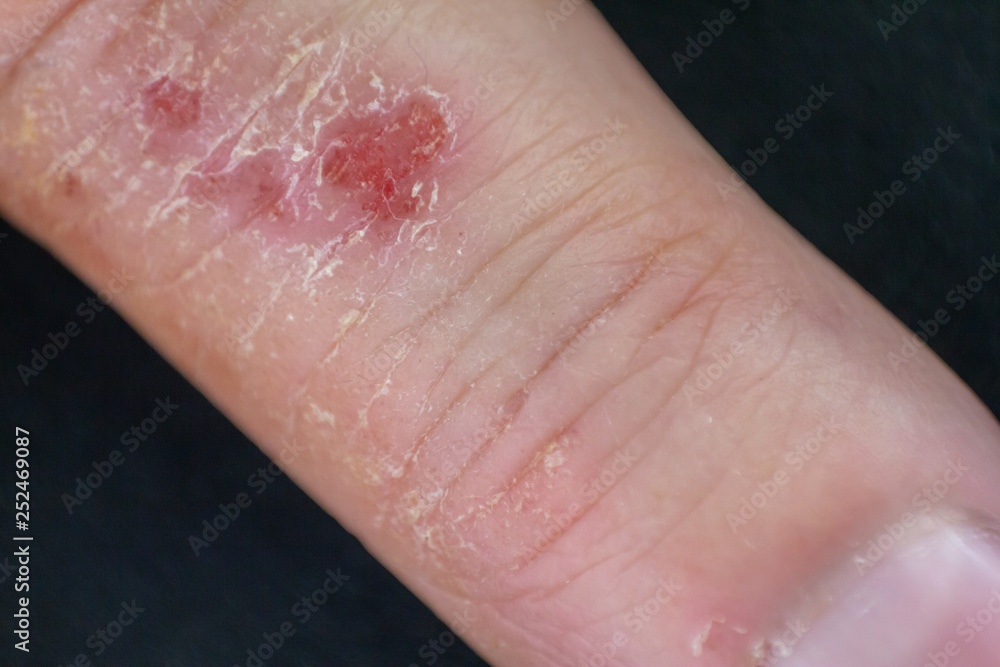 Hand dermatitis. Finger eczema Stock Photo | Adobe Stock