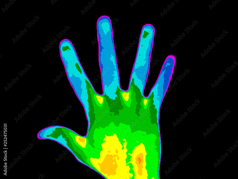 Thermographic photo of the palm of a persons hand, the photo showing ...