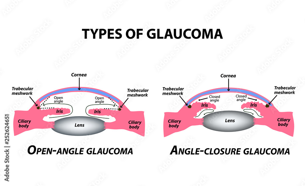 Types of glaucoma. Open-angle and angle-closure glaucoma. The ...