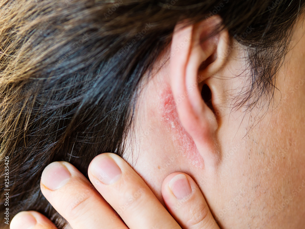 Irritation on the skin behind the ear. Man with flaky skin. Allergy or ...