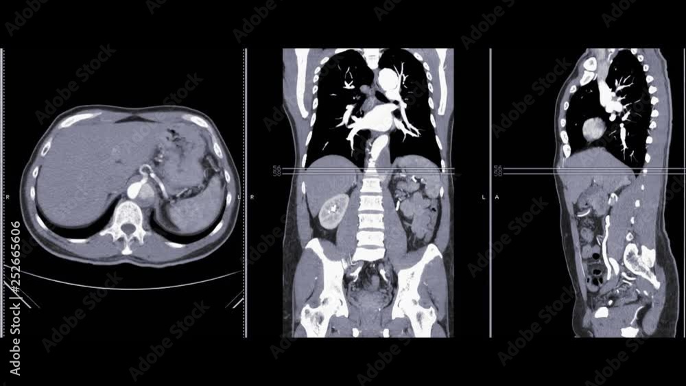 Computed tomography of CTA abdominal aorta coronal plane , axial ...