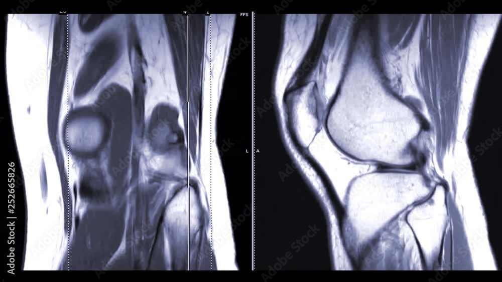 magnetic resonance imaging or MRI Knee coronal and sagittal plane ...