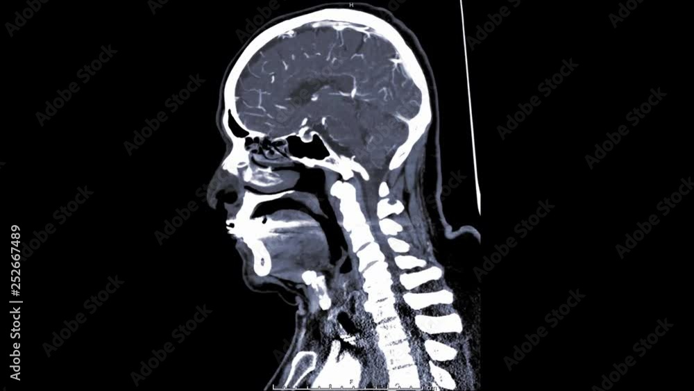 computed tomography angiography, CTA brain and neck 3D Rendering image ...