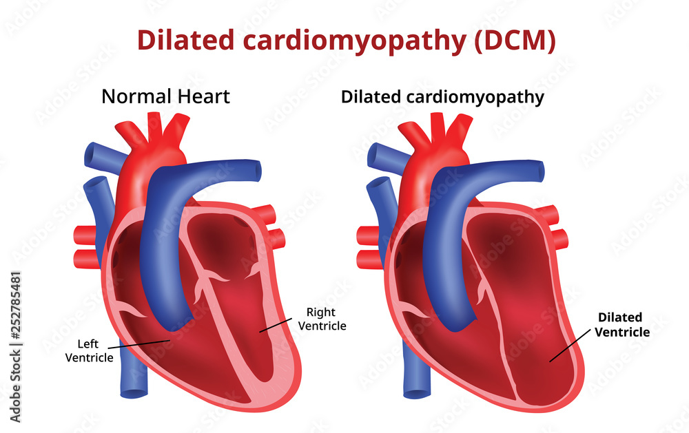 Dilated cardiomyopathy, Heart disease, Vector image Stock Vector | Adobe Stock