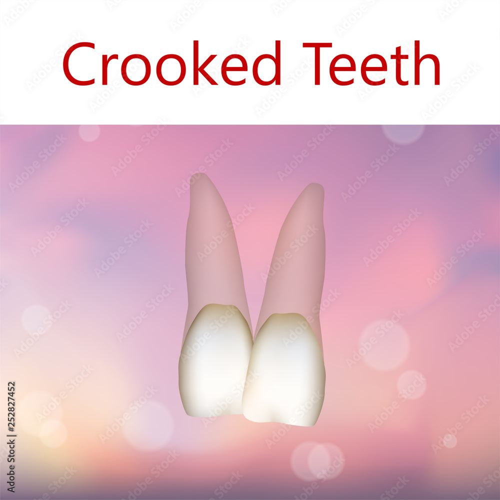 Croocked Teeth. Vector realistic anatomy illustration. Pink abstract ...