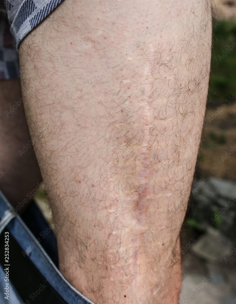 Foto Stock Bad scar on the man's leg surgery. Medical treatment disease ...