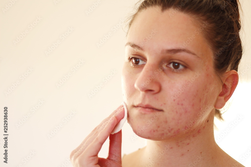 Acne on the face of young women. Improper therapy has led to a severe ...