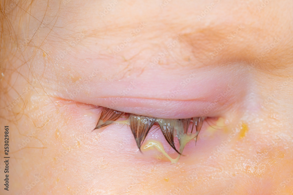 Swollen and sticky eyelid of a small baby with conjunctivitis Stock ...
