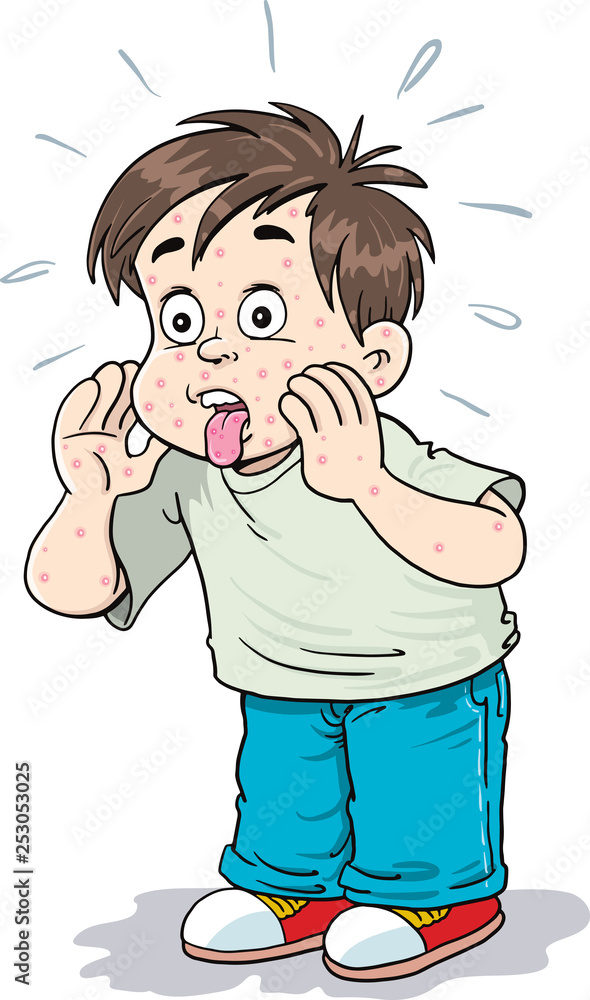 child with a rash on his body Stock Vector | Adobe Stock
