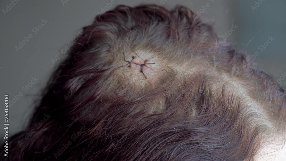 two stitches on the girl's head after surgery to remove a wen. shaved ...