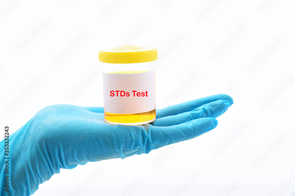Urine sample for sexually transmitted diseases or STDs test Stock Photo ...