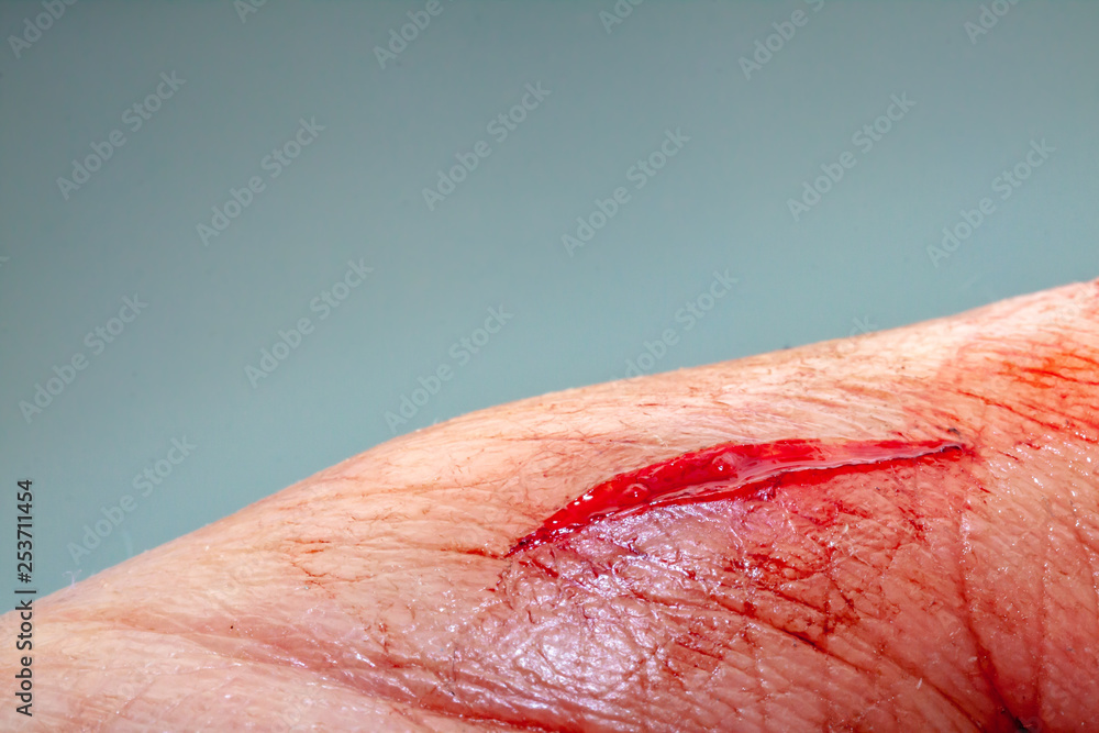 One photo of a series of photos taken of a fresh bleeding cut ...