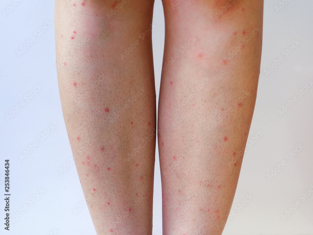 Legs with many red spot and scar from mosquitos bites (insect ...