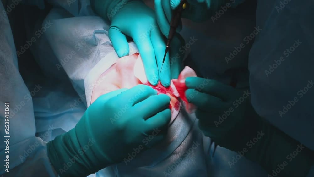 The surgeon is performing an operation on the eyes, close-up. The ...