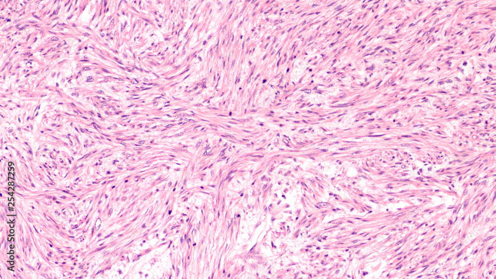 Foto de Microscopic image of a leiomyosarcoma, a type of soft tissue ...