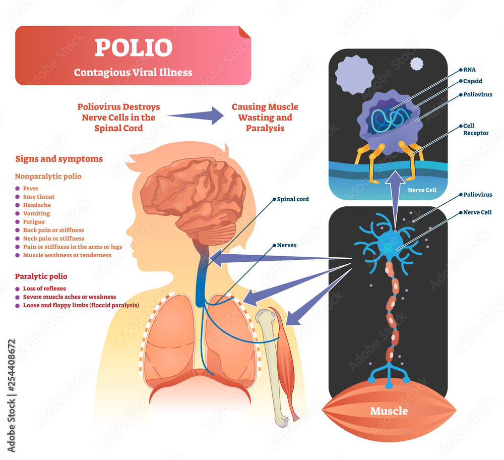 Vetor de Polio vector illustration. Labeled medical virus infection symptoms scheme. do Stock ...