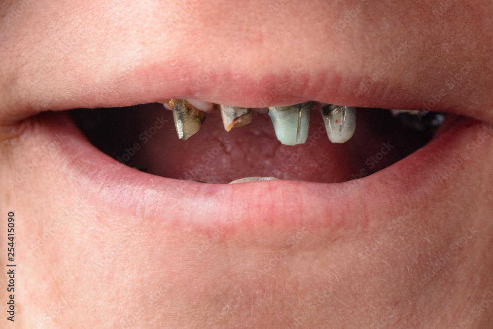 The woman opened her mouth wide, and showed her crooked and rotten ...