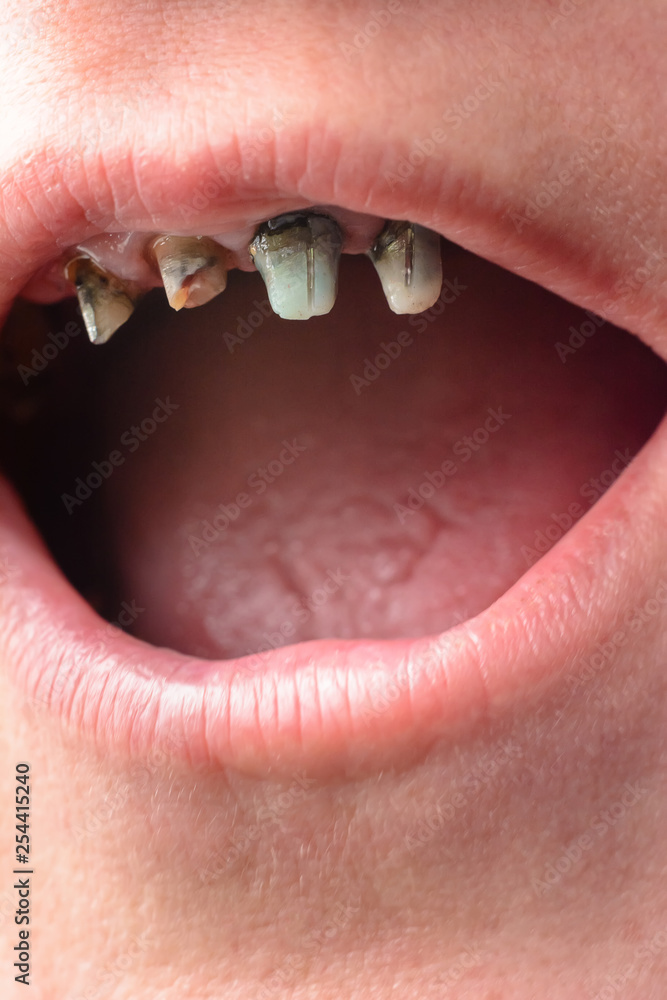 The woman opened her mouth wide, and showed her crooked and rotten ...