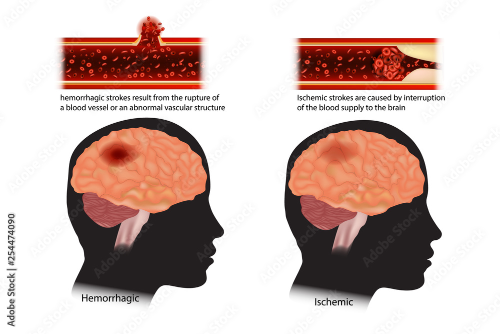 Naklejka Diagram of the two types of stroke. Strokes classified ...