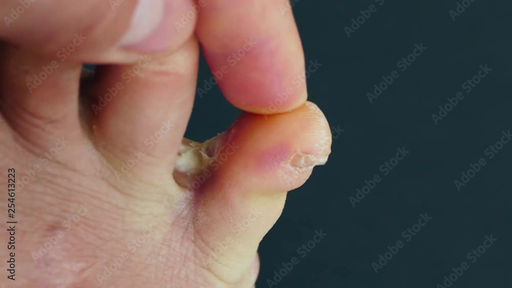 Fungal disease between toes, a human foot with foot care, neglected and ...